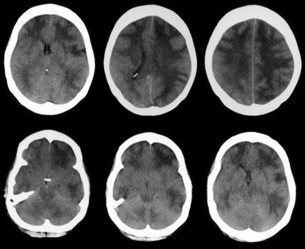Cerebral Edema Cerebral Edema